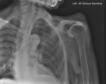 Geyser Sign - WikiSM (Sports Medicine Wiki)