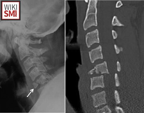 Cervical Teardrop Fracture - WikiSM (Sports Medicine Wiki)