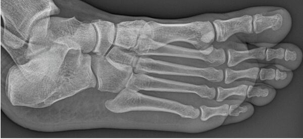 Calcaneocuboid Joint - WikiSM (Sports Medicine Wiki)