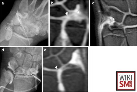 TFCC Tear - WikiSM (Sports Medicine Wiki)