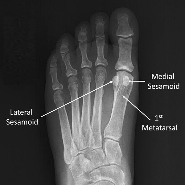 Metatarsosesamoid Joint Injection - WikiSM (Sports Medicine Wiki)