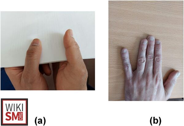 Wartenbergs Sign - WikiSM (Sports Medicine Wiki)