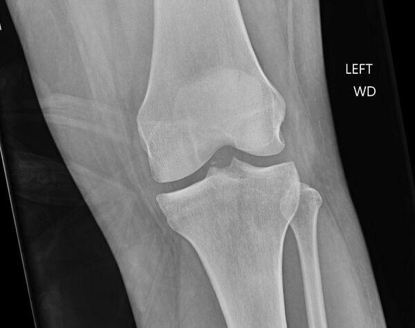 ACL Tear - WikiSM (Sports Medicine Wiki)
