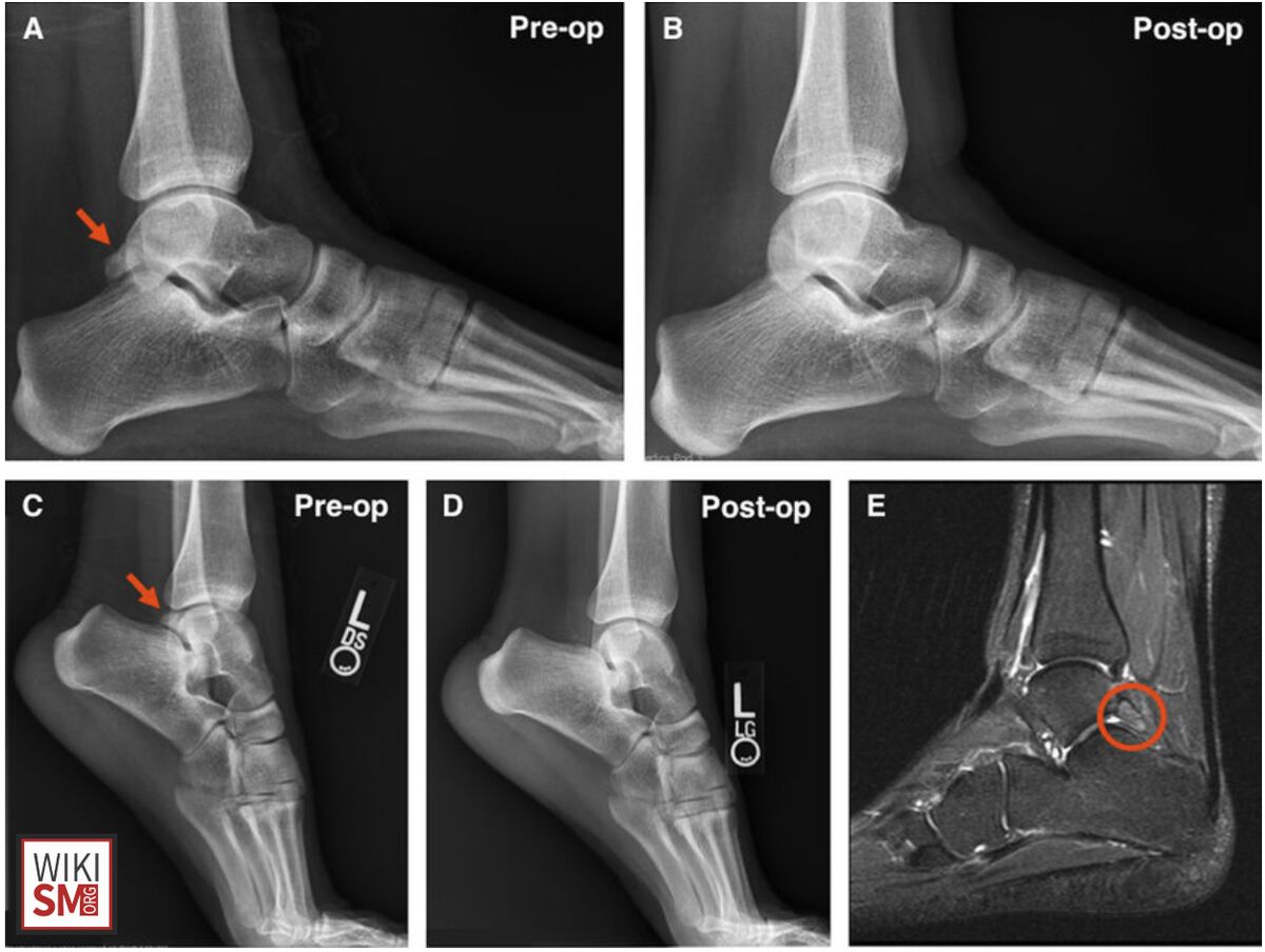 Os Trigonum - WikiSM (Sports Medicine Wiki)