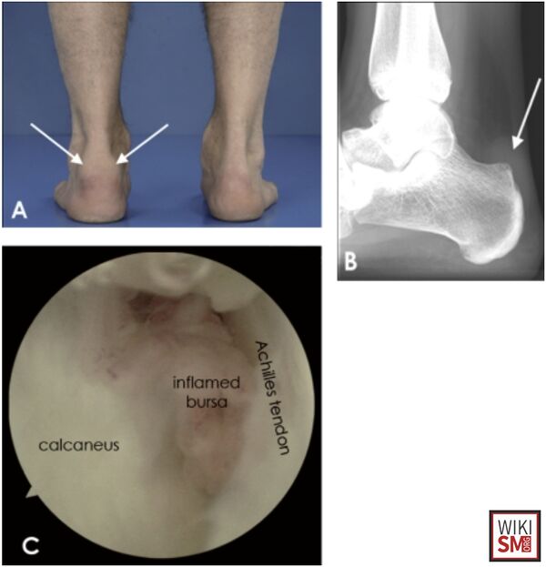 Retrocalcaneal Bursitis - WikiSM (Sports Medicine Wiki)