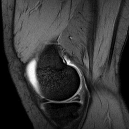 Meniscus Tears - WikiSM (Sports Medicine Wiki)