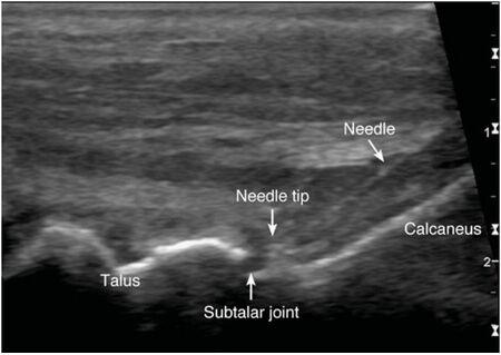 Subtalar Joint Injection - WikiSM (Sports Medicine Wiki)