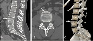 Limbus Vertebra - WikiSM (Sports Medicine Wiki)