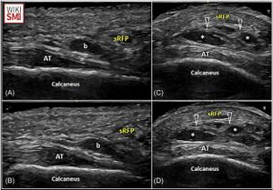 Retrocalcaneal Bursitis - WikiSM (Sports Medicine Wiki)