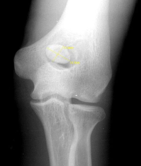 Accessory Bones of the Elbow - WikiSM (Sports Medicine Wiki)