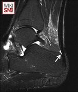 Retrocalcaneal Bursa - WikiSM (Sports Medicine Wiki)