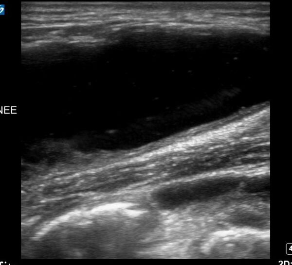 Baker's Cyst - WikiSM (Sports Medicine Wiki)