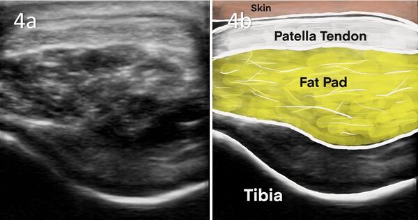 Patellar Tendon - WikiSM (Sports Medicine Wiki)