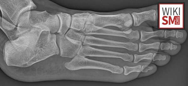 Cuboid Syndrome - WikiSM (Sports Medicine Wiki)