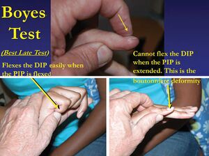 Boyes Test - WikiSM (Sports Medicine Wiki)