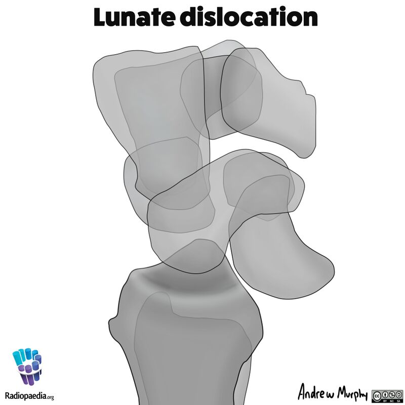 Lunate Dislocation - WikiSM (Sports Medicine Wiki)