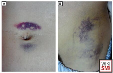 Cullen Sign - WikiSM (Sports Medicine Wiki)