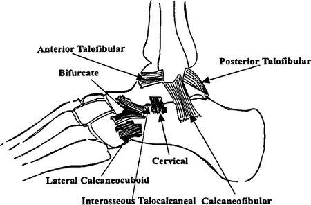 Sinus Tarsi Syndrome - WikiSM (Sports Medicine Wiki)