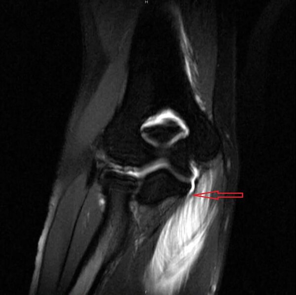 UCL Tear - WikiSM (Sports Medicine Wiki)