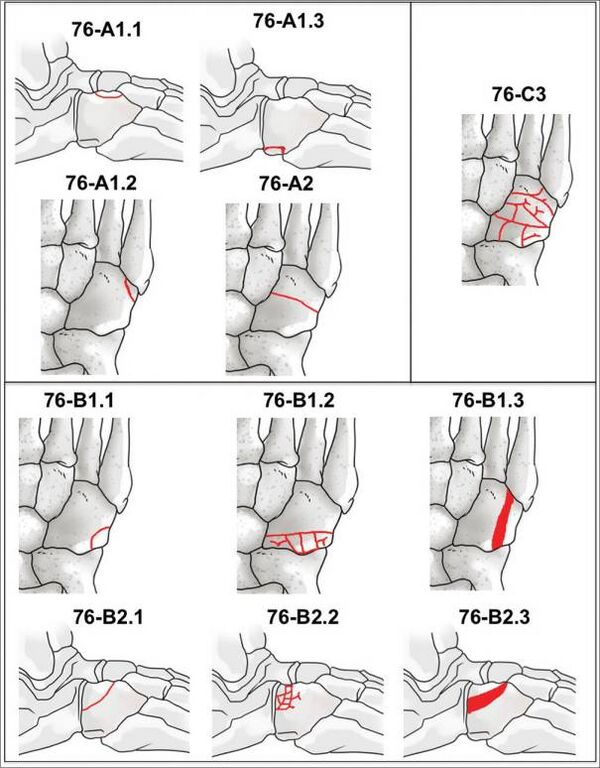 Cuboid Fracture - WikiSM (Sports Medicine Wiki)