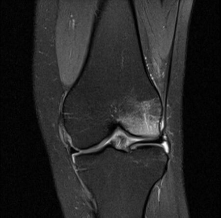 ACL Tear - WikiSM (Sports Medicine Wiki)