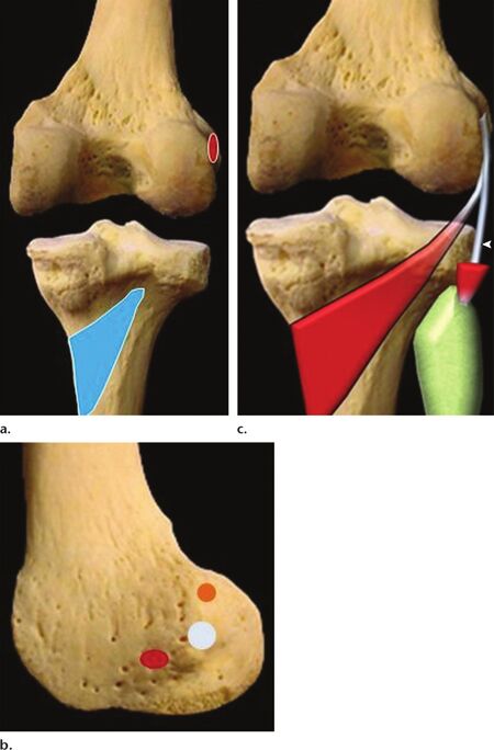 Popliteus - WikiSM (Sports Medicine Wiki)