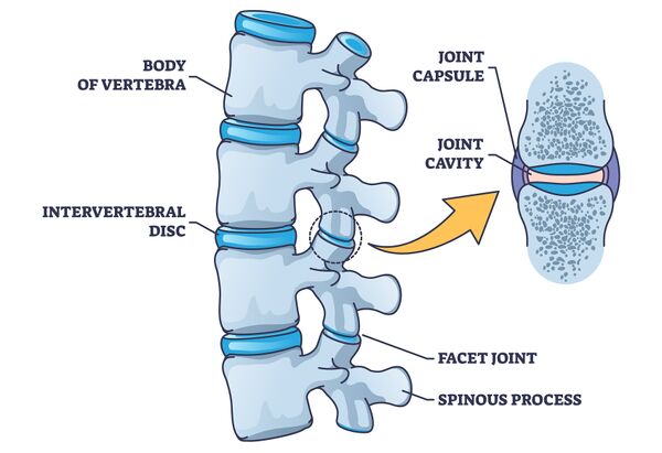 Facet Joint Pain and Arthritis - WikiSM (Sports Medicine Wiki)
