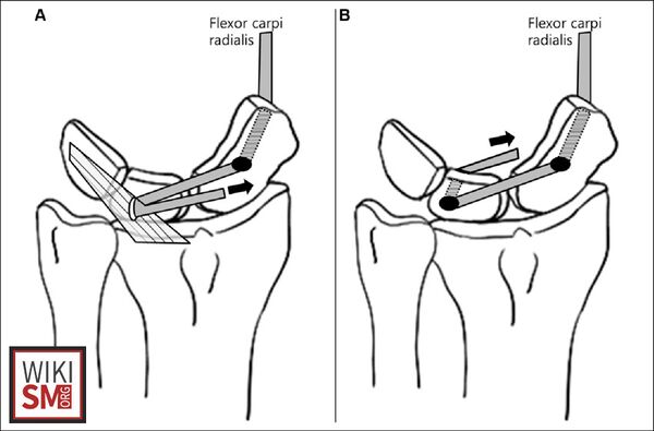Scapholunate Instability - WikiSM (Sports Medicine Wiki)