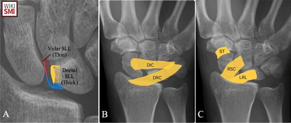 Scapholunate Ligament - WikiSM (Sports Medicine Wiki)