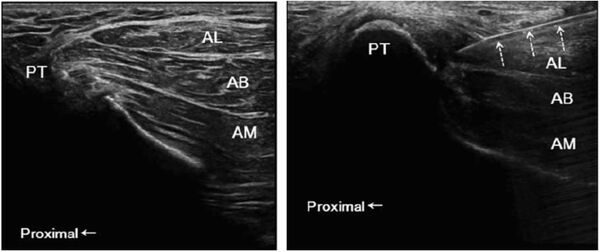 Adductor Tendon Percutaneous Needle Tenotomy - WikiSM (Sports Medicine ...