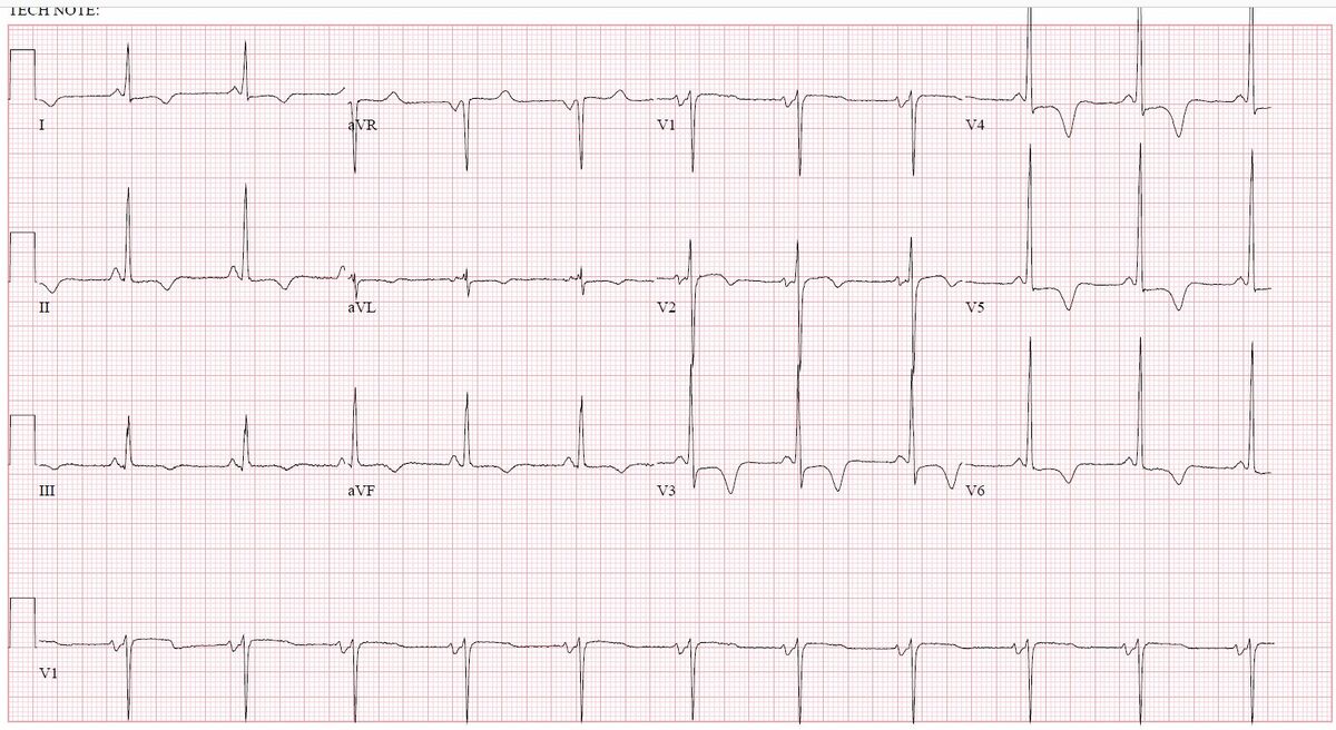 Cardiomyopathy Hypertrophic Representation Abbreviations Explanation ...