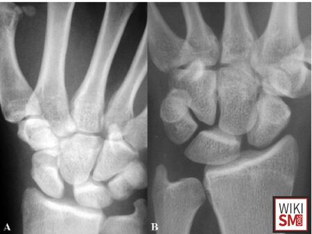 Scapholunate Joint - WikiSM (Sports Medicine Wiki)