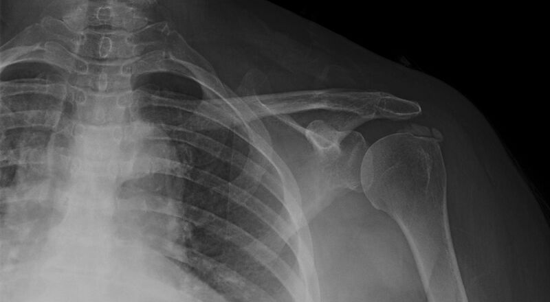 Calcific Tendinitis of the Rotator Cuff - WikiSM (Sports Medicine Wiki)