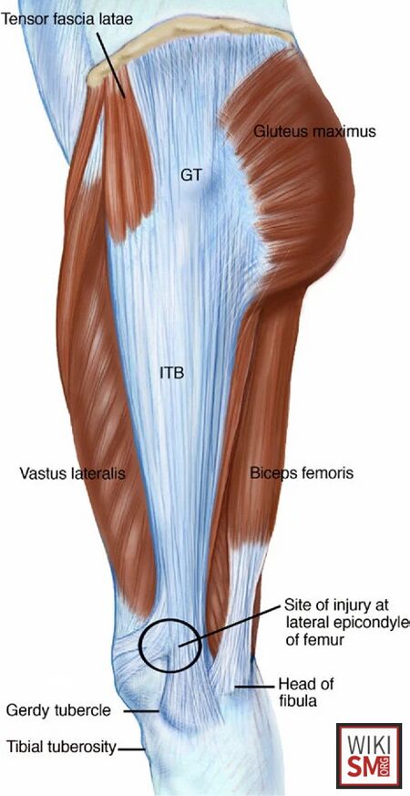 Tensor Fasciae Latae - WikiSM (Sports Medicine Wiki)