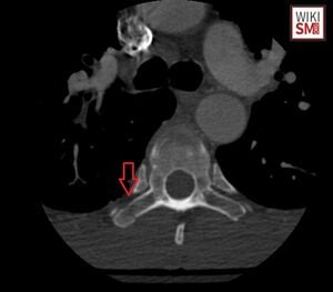Transverse Process Fracture - WikiSM (Sports Medicine Wiki)