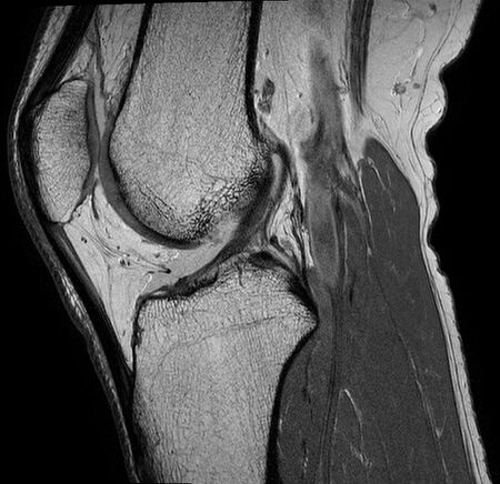 Anterior Cruciate Ligament - WikiSM (Sports Medicine Wiki)
