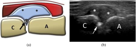 Acromioclavicular Joint Injection - WikiSM (Sports Medicine Wiki)