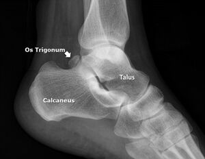 Os Trigonum - WikiSM (Sports Medicine Wiki)