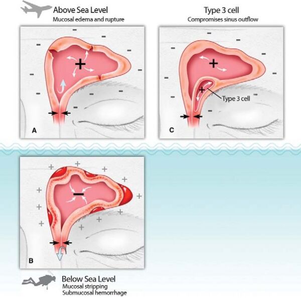 Sinus Barotrauma - WikiSM (Sports Medicine Wiki)