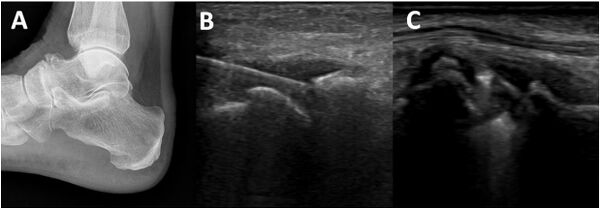 Talonavicular Joint Injection - WikiSM (Sports Medicine Wiki)