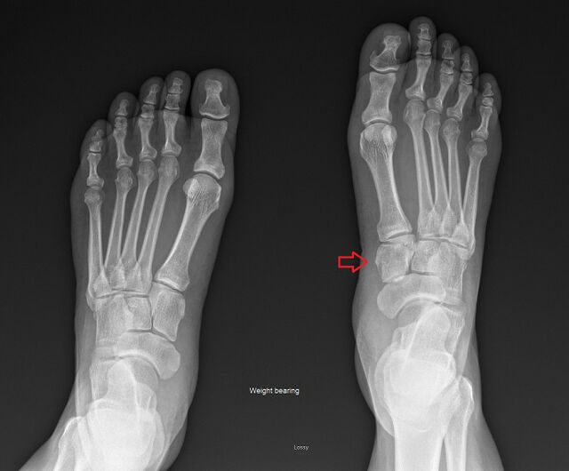 Cuneiform Fracture - WikiSM (Sports Medicine Wiki)