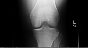 Standard Radiographs Knee - WikiSM