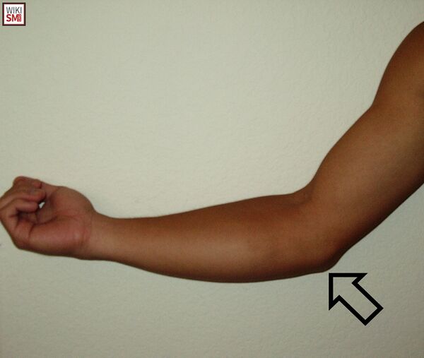 UCL Tear of the Elbow - WikiSM (Sports Medicine Wiki)