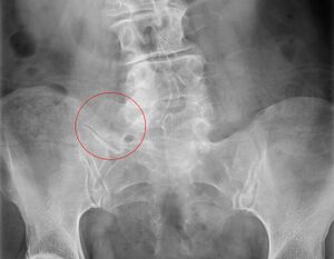 Bertolottis Syndrome - WikiSM (Sports Medicine Wiki)