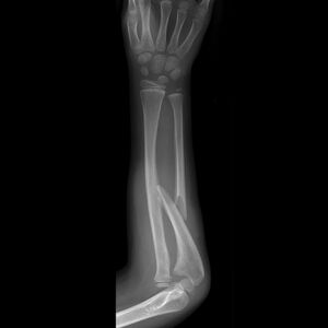 Monteggia Fracture - WikiSM (Sports Medicine Wiki)