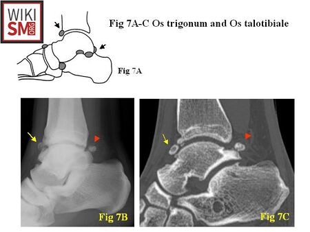 Os Trigonum - WikiSM (Sports Medicine Wiki)