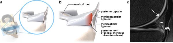 Meniscocapsular Ligament - WikiSM (Sports Medicine Wiki)