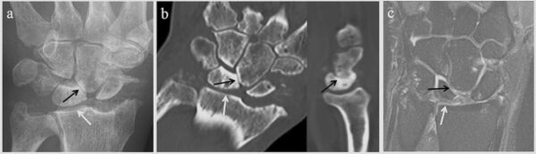 Scapholunate Instability - WikiSM (Sports Medicine Wiki)