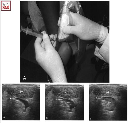 Retrocalcaneal Bursitis - WikiSM (Sports Medicine Wiki)