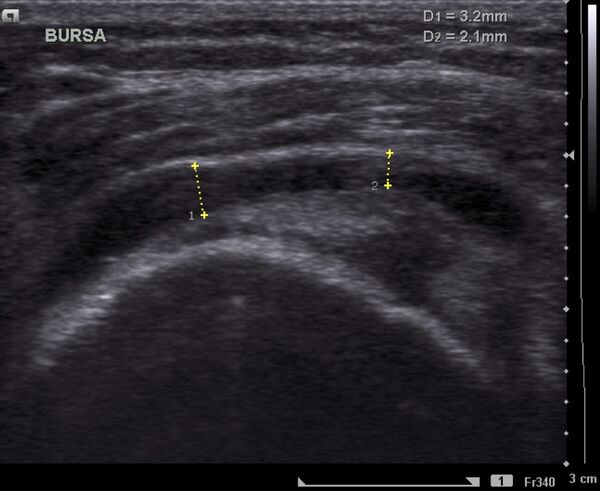 Bursa of the Shoulder - WikiSM (Sports Medicine Wiki)